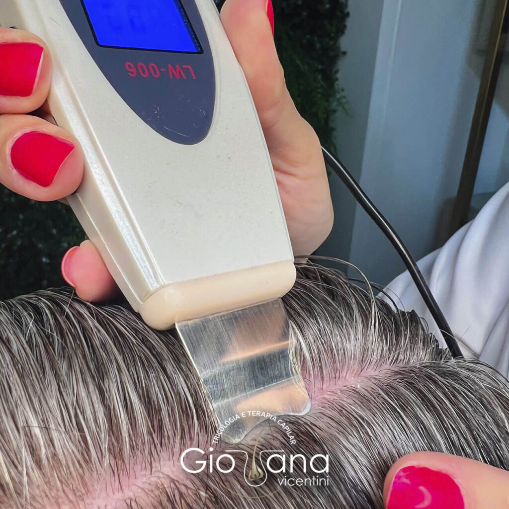 Peeling ultrassônico - Giovana Vicentini Tricologista